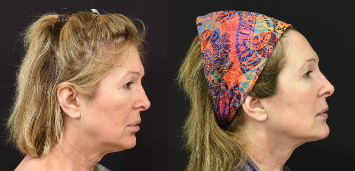 Neck Lift Before & After Images - Harmon Facial Plastic Surgery